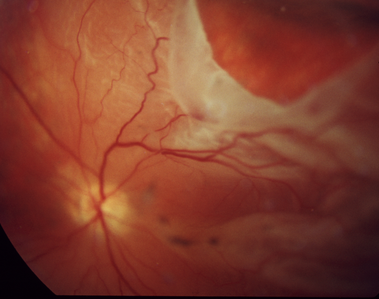 Ablatio Retinae (Netvliesloslating) - Irisonline.eu Kijkt verder...